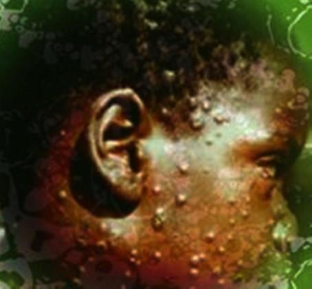 Suspected Mpox case under investigation, patient isolated: Centre ...