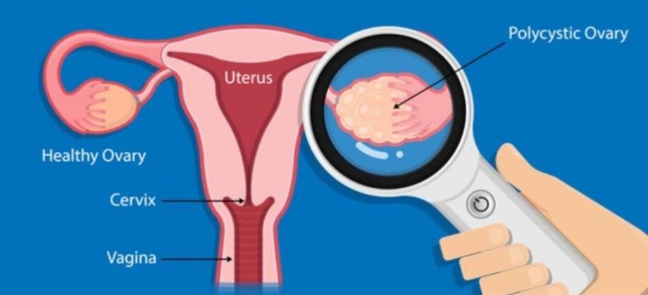 Women with PCOS likely to have attention, cognitive issues: Study ...